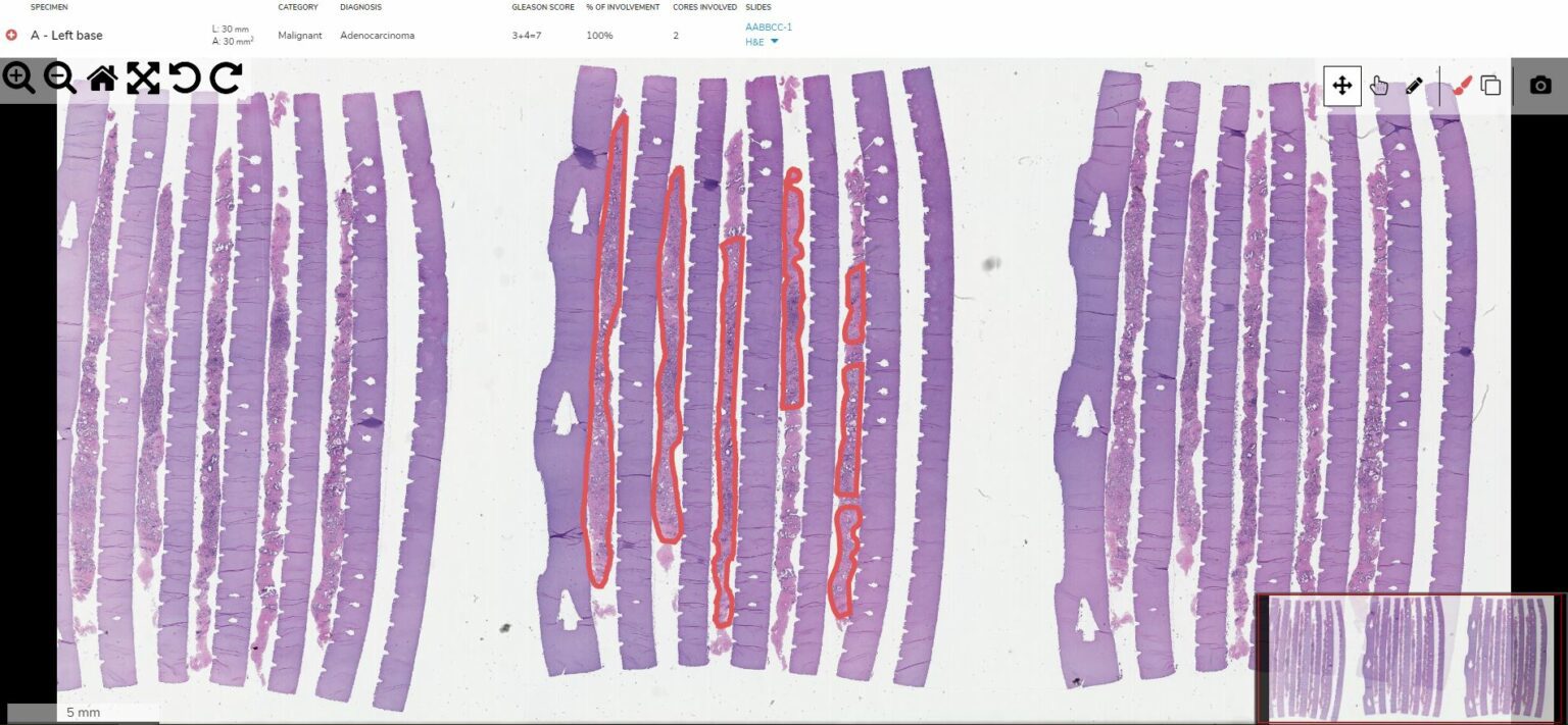 Digital Pathology Technology for Prostate Cancer | Lumea