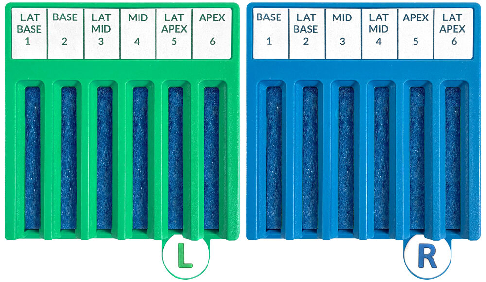 Digital Pathology Technology for Prostate Cancer | Lumea